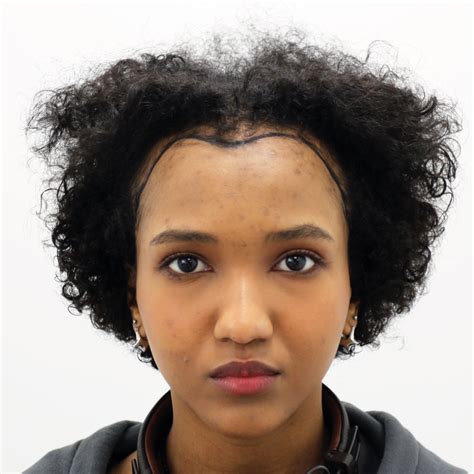 Black Women Hair Transplant Dr Resul Yaman Hair Clinic