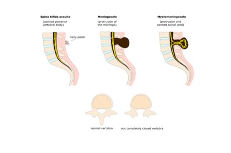 Prevention Of Neural Tube Defects Hqzy
