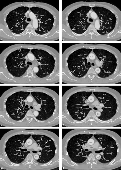 Pulmonary Artery Segmental Anatomy