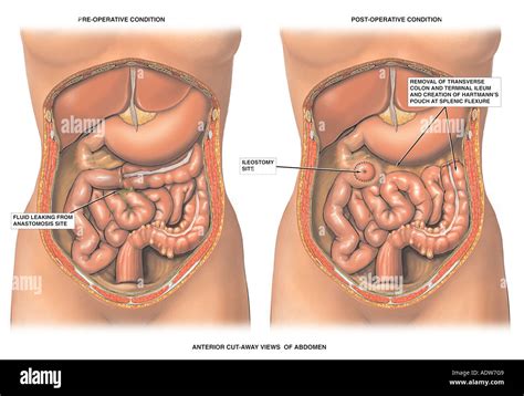Transverse Procedure Hi Res Stock Photography And Images Alamy