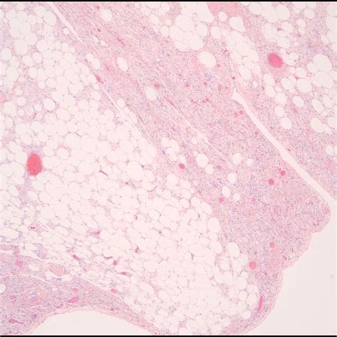 Fat Necrosis And Foamy Histiocytes Demonstrating Diagnosis Of