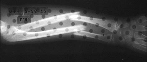 7 Forearm Fractures Closed Treatment Musculoskeletal Key