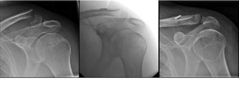 Figure 3 From Percutaneous Endobutton Fixation Of Acute Acromioclavicular Joint Injuries And