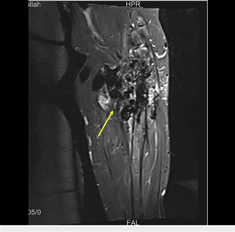 Figure 1 From Arteriovenous Malformation Presenting With Bone