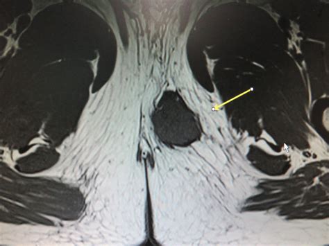 Mri Revealed A Perineal Tumor The Arrow Points Out The Location Of The