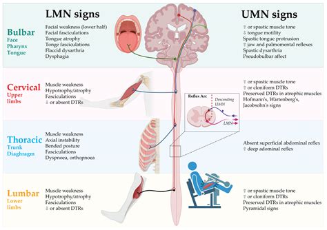 Motor Neurone Disease Amyotrophic Lateral Sclerosis Geeky Medics