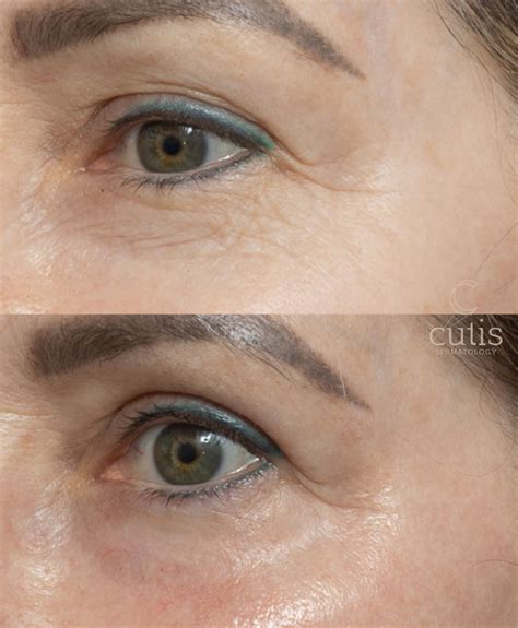 Eye Wrinkle Treatment Co2 Laser Cutis Clinic