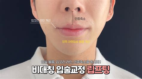 입술필러 입꼬리필러 보톡스 인중축소를 이용한 입술 비대칭 교정 ㅣ 립프팅 😘 Youtube