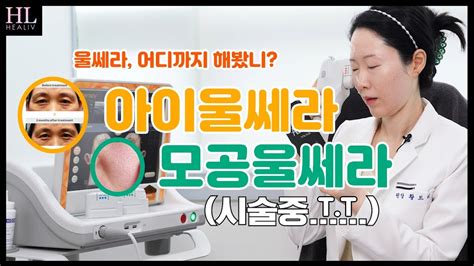 울쎄라 어디까지 해봤니 특수부위 울쎄라 셀프시술 아이울쎄라 And 모공울쎄라 강남피부과 울쎄라 아이울쎄라 모공 눈꺼풀처짐 안검하수 Youtube
