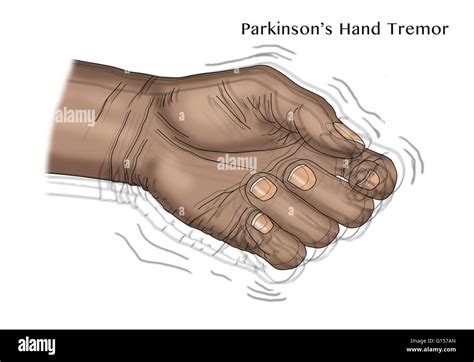 Illustration Of A Hand Tremor One Of The Symptoms Of Parkinsons