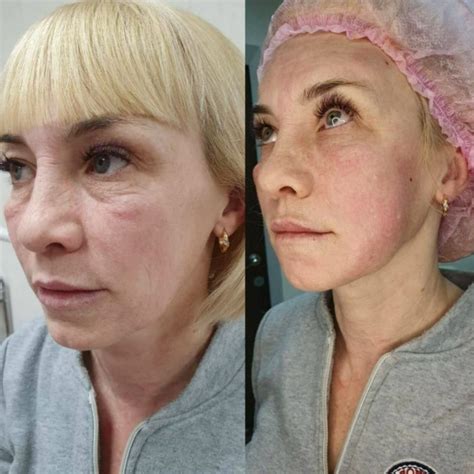 ПОЛИМОЛОЧНАЯ КИСЛОТА это про молодость процедура омоложения кожи за