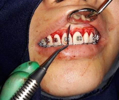 Gingival Margin Contouring With Kirkland Knife Download Scientific