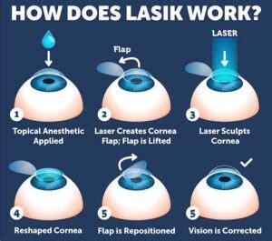 Ultra Lasik In Dubai North American Lasik And Eye Surgery