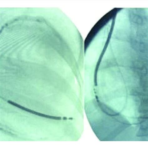 Fluoroscopy During Device Implantation Crt Icd The Left Image Shows