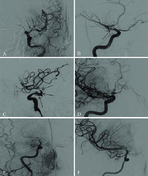Findings On Dsa Revealing Intracranial Arterial Dissection A Download Scientific Diagram