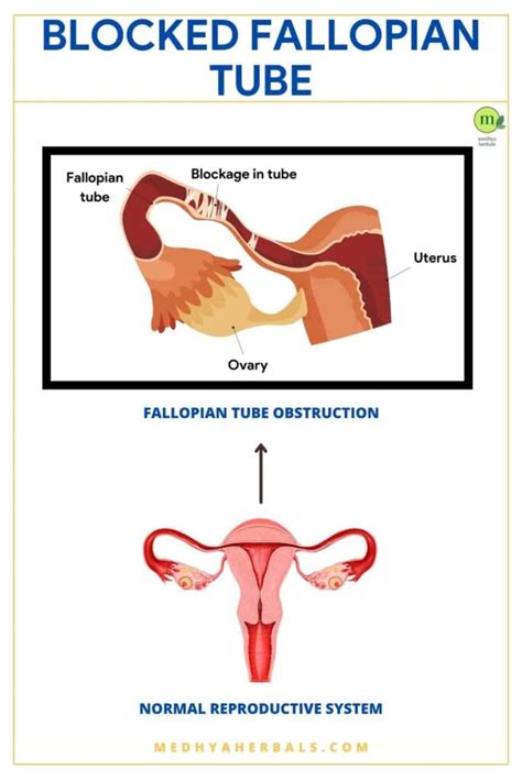 The Best Ayurveda Treatment For Blocked Fallopian Tubes And Fertility