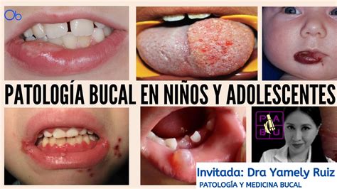PatologÍa Bucal En NiÑos Y Adolescentes Con Dra Yamely Ruiz Vazquez