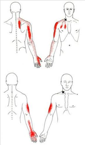 Trigger Points Flashcards Quizlet
