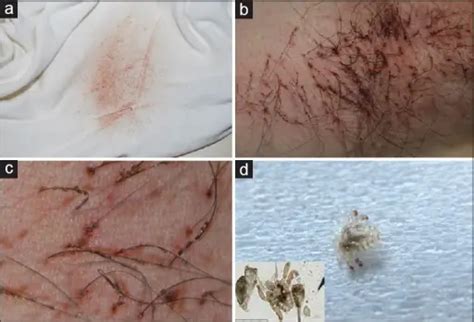 What Is Lice Pathosomes