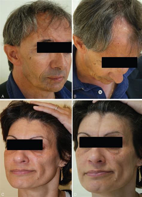 Case 1 A And B Right Facial Atrophy With Frontal Linear Scleroderma Download Scientific