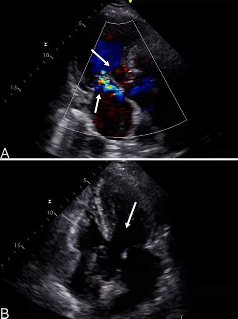 Echocardiography Postoperativelythe Mitral Valve Regurgitation Was