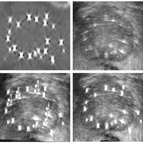 Pdf L 125 Seed Implants For Prostate Brachytherapy Physical