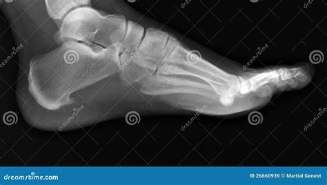 X-Ray stock image. Image of foot, image, side, bone, visible - 26660939