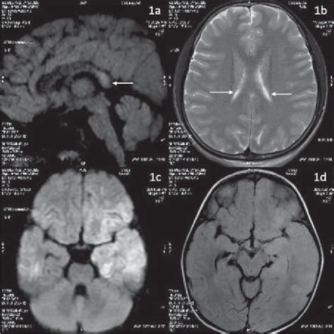 Mri Scan Brain Showing Restricted Diffusion In Splenium Of Corpus