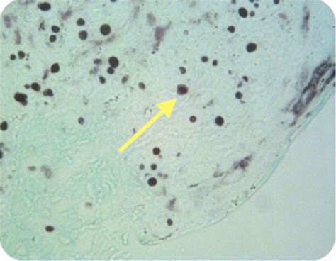 Case 2—encapsulated Cryptococcal Organisms Arrow Methanamine Silver Download Scientific