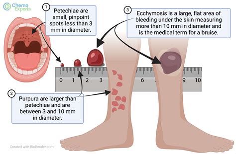 Bleeding Into The Skin Petechiae Purpura Ecchymosis Chemoexperts