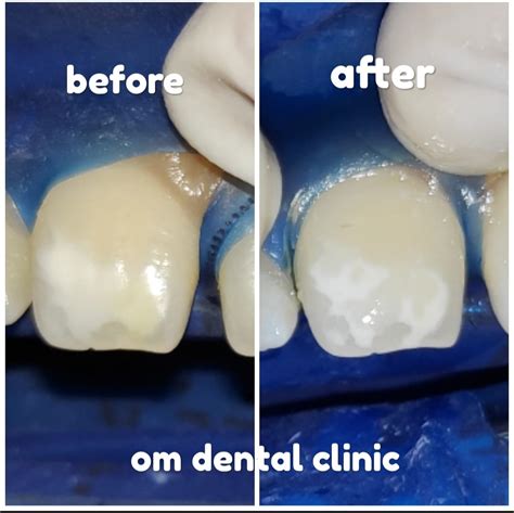 Hypocalcification Of Central Incisor In Om Dental Clinic