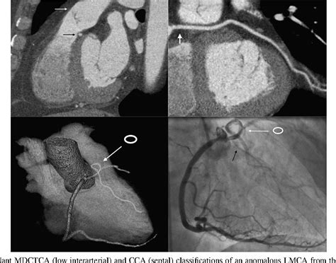 Anterior Aortic Sinus Semantic Scholar