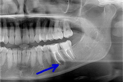 Chistectomie Cabinet Stomatologic Happydent Bacău