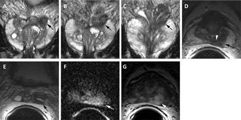Prostate Imaging Reporting And Data System Version 21 2019 Update Of