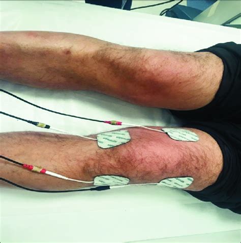 Interferential Current Application Download Scientific Diagram