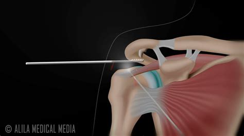 Subacromial Bursitis Carolina Regional Orthopedics