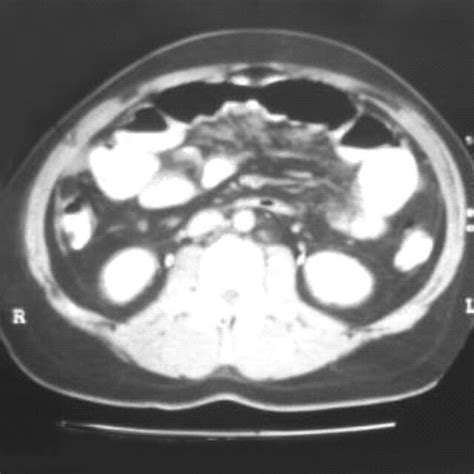 Pdf Carcinoid Tumor Of The Appendix Case Presentation