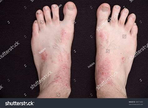 Dermatitis On Your Feet At Esther Corbett Blog