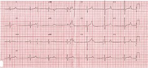 Baseline Electrocardiogram Demonstrates Prolonged Qt Interval With Qtc Download Scientific