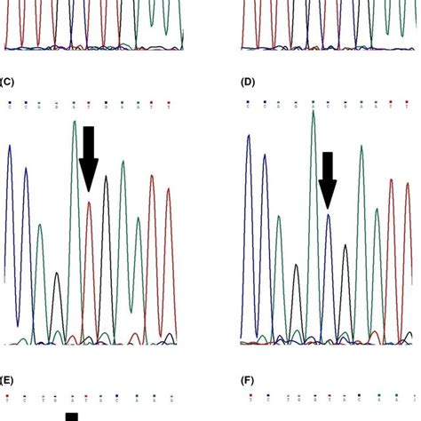 The Sequence Chromatographs Of Mutations Detected In The Patients 2 3