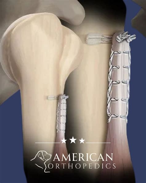 Biceps Tenotomy And Tenodesis American Orthopedics