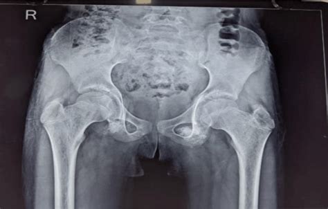 Plain Radiograph Of Pelvis Showing Fluffy Soft Tissue Calcifications Download Scientific