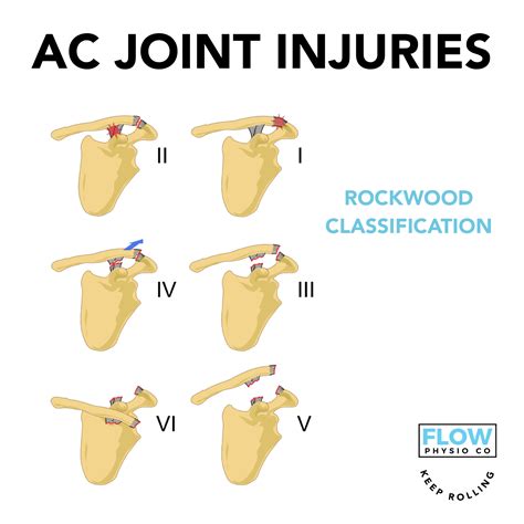 Acromioclavicular Joint Sprain