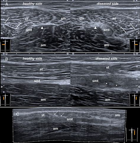Hamstring Ultrasound Protocol At Jenenge Blog