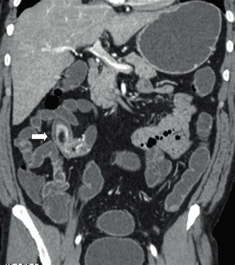 61 Year Old Man Ct Enterography With Peg Shows An Intraluminal Mass Download Scientific