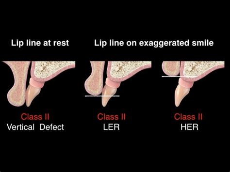 Assessing Esthetic And Structural Risk With Lip Tooth Ridge