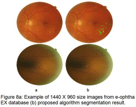 detection of hard exudates based on morphological feature extraction biomedical and