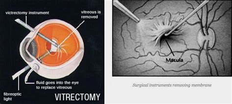 Epiretinal Membrane Surgery Durban Retinal Associates