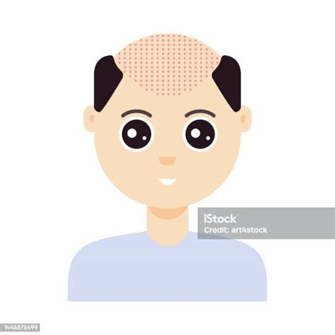 탈모증의 Fue 모발 이식 치료 Hair Transplant에 대한 스톡 벡터 아트 및 기타 이미지 Hair Transplant 건강 진단 건강관리와 의술 Istock