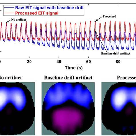 The Dwt Processing Results For Baseline Drifting Removal In Patient Download Scientific Diagram